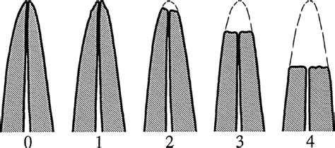 Clear Aligner Orthodontic Treatment And Root Resorption Renstrom Dental