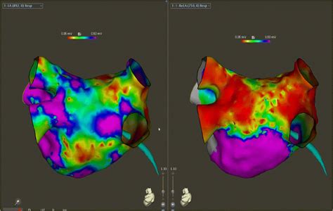 Posterior View Of The Left Atrium Comparing Voltage Maps Pre Left