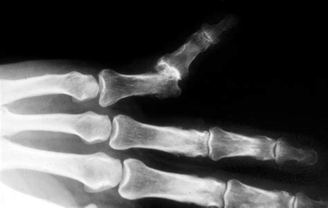 Dislocation Finger Proximal Interphalangeal Pip Joint Hand Surgery Resource