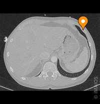 Costelas Falsas E Anatomy Imaios