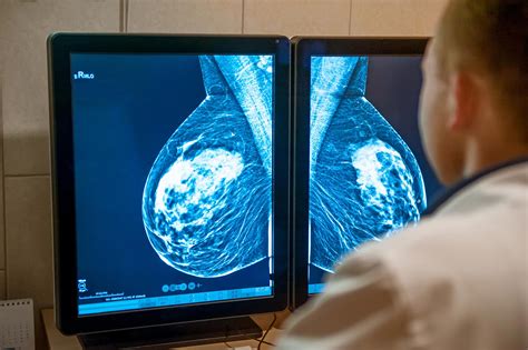 Deep Learning Artificial Intelligence Predicts Breast Cancer Risk Better