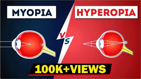 Explain The Difference Between Myopia And Hyperopia