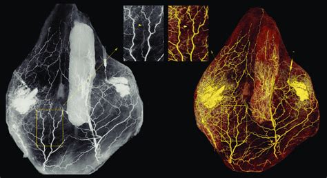 Angiographic Images Acquired Using Soft Tissue X Ray And Download Scientific Diagram