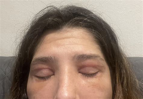 Blepharoplasty Support Group My Doctor Told Me Not To Put Any Creams