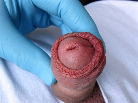 Penatalaksanaan Balanitis Alomedika