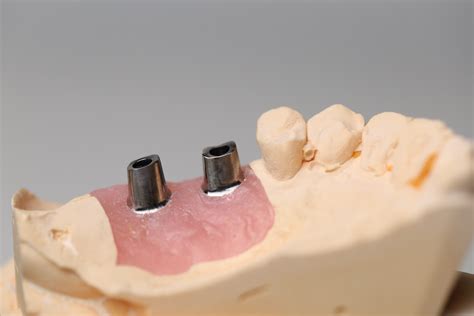 Customized Abutment