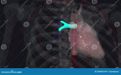 Anterior Segmental Artery Of Right Lung Stock Footage Video Of Vessel Catheterisation 290835104
