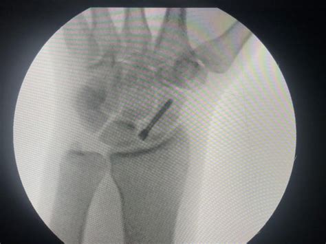 Scaphoid Proximal Pole Fracture R Radiology