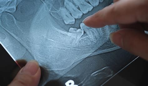 Do You Really Need Your Wisdom Teeth Removed Heres What To Know
