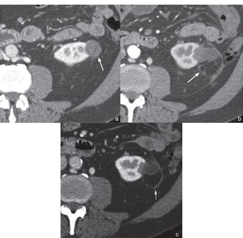 Figure 110 From Subtotal Nephrectomy And Tumour Ablation Semantic
