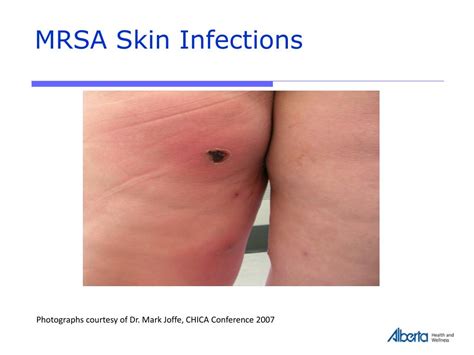 Ppt Provincial Mrsa Infection Prevention And Control Ipc Guidelines