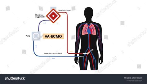 Venoarterial Extracorporeal Membrane Oxygenation Va Ecmo Stock Vector