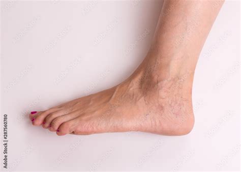 Varicose Veins On The Female Foot Varicose Veins Closeup Leg Of A
