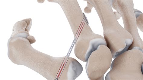 Cmc Archives Dunamis Medical