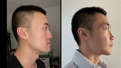 Underbite Braces Surgery Cost At Clayton Cooper Blog