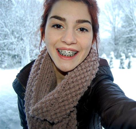 Cd Adlı Kullanıcının Braces Panosundaki Pin