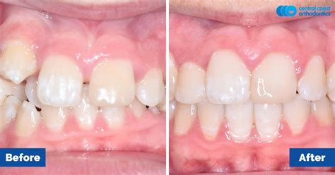 Patient Of Lisarows Braces Makeover Central Coast Orthodontics