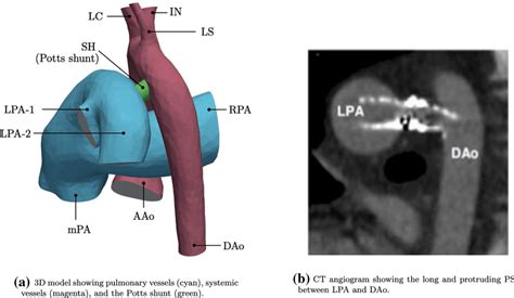 3d Reconstruction Of The Patient Anatomy And Ct Angiogram Labels Are Download Scientific