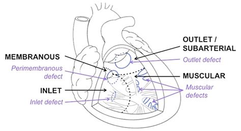 Ventricular Septal Defects Wfsa Resources