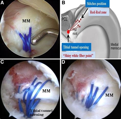 Meniscus Scope