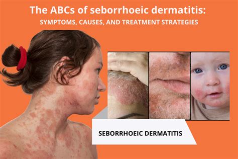 Seborrhoeic Dermatitis Seborrhoeic Dermatitis Image