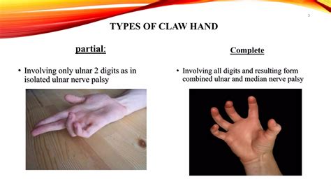 Claw Hand Definition Causes Types Symptoms And Management Pptx