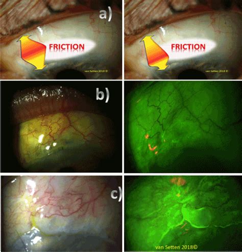 Filtration Bleb At Josephine Lewis Blog
