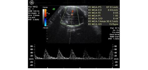 Doppler Indices Of Fetal Mca Before Progesterone Administration Im