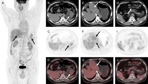 68ga Fapi 04 Petct Versus 18f Fdg Petct In The Detection O