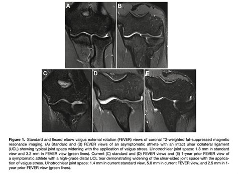 新しい肘の評価法「fever View Mri」は選手のパフォーマンスを予測できるか？｜キム・ヒョン