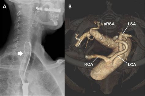 Left Subclavian Artery Figure 1 From The Aberrant Right Subclavian
