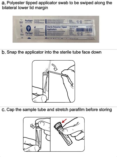 Steps In Obtaining Lower Lid Margin Sample A Polyester Tipped