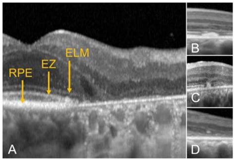 Optical Coherence Tomography In Inherited Macular Dystrophies A Review
