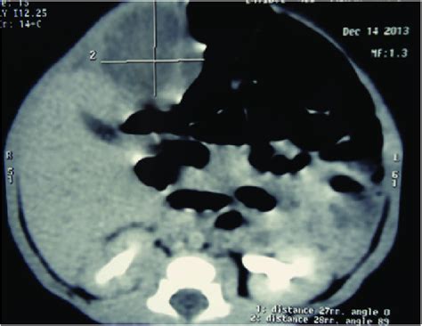 The Computed Tomography Of Abdomen In Axial Cut Shows The Abcess Cavity