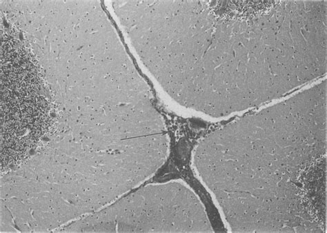 This Photomicrograph Shows Large Pleomorphic Cells With Hyperchromatic