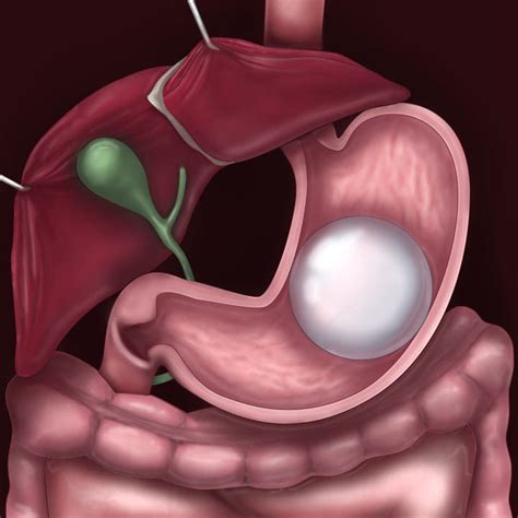 Intragastric Balloon Ohio State Bariatric Surgery
