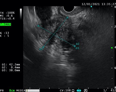 Endoscopic Ultrasound Fine Needle Biopsy Fine Needle Biopsy Of The