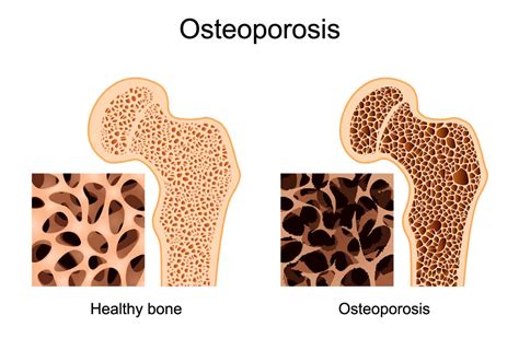 Osteoporosis When Bones Break Easily The West End News