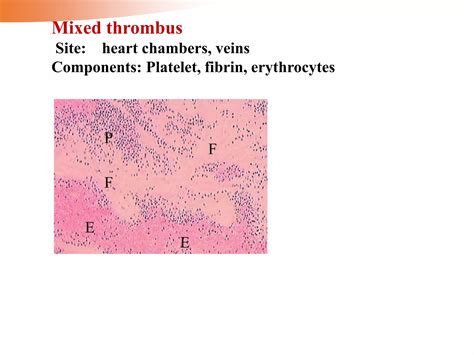 Hemodynamic Disorders Ppt