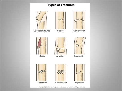 Fracture Chapter 4 Presentation