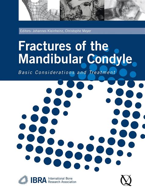 Buy Fractures Of The Mandibular Condyle Basic Considerations And