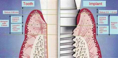What Is Biologic Width