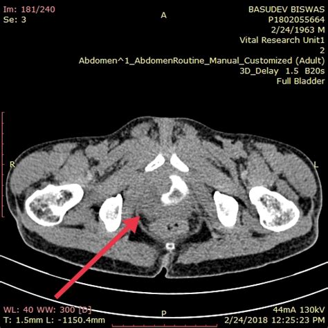 Prostatic Malignancy Radiology Upper End Of Right Femur Cyst In
