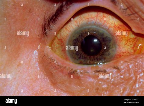 Close Up Of A Sore Inflamed Eye In Acute Glaucoma With An Irregular Enlarged Pupil Glaucoma