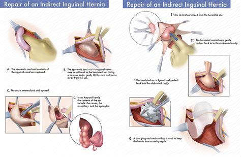 Anatomy Of Inguinal Hernia Repair