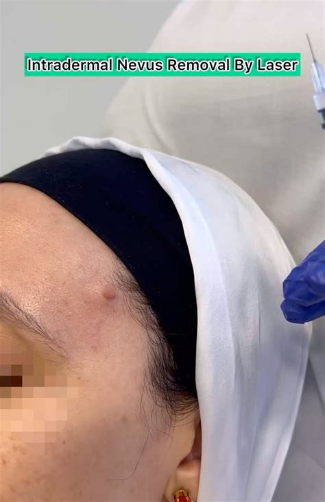 Intradermal Nevus Removal