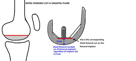Tka Bone Cuts — Hip And Knee Book