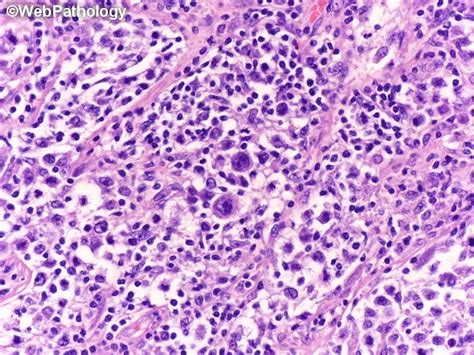 Pmlbcl Microscopic Features