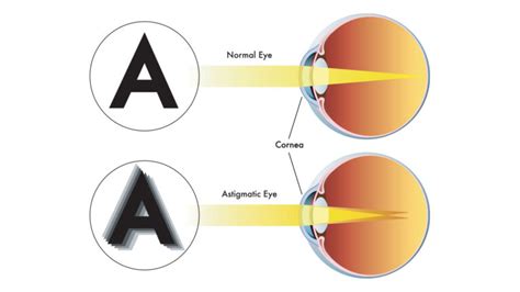 Presbyopia Vs Astigmatism London Eye Clinic Explains