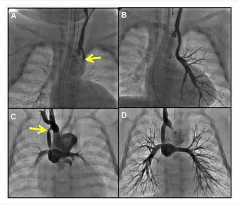 Figure 1 From Intervention On Surgical Systemic To Pulmonary Artery